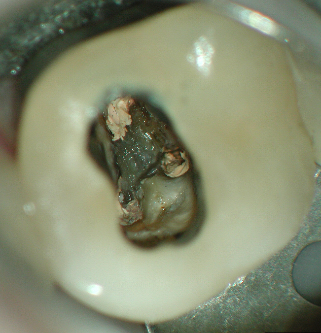 3) access – Modern Endodontic Care