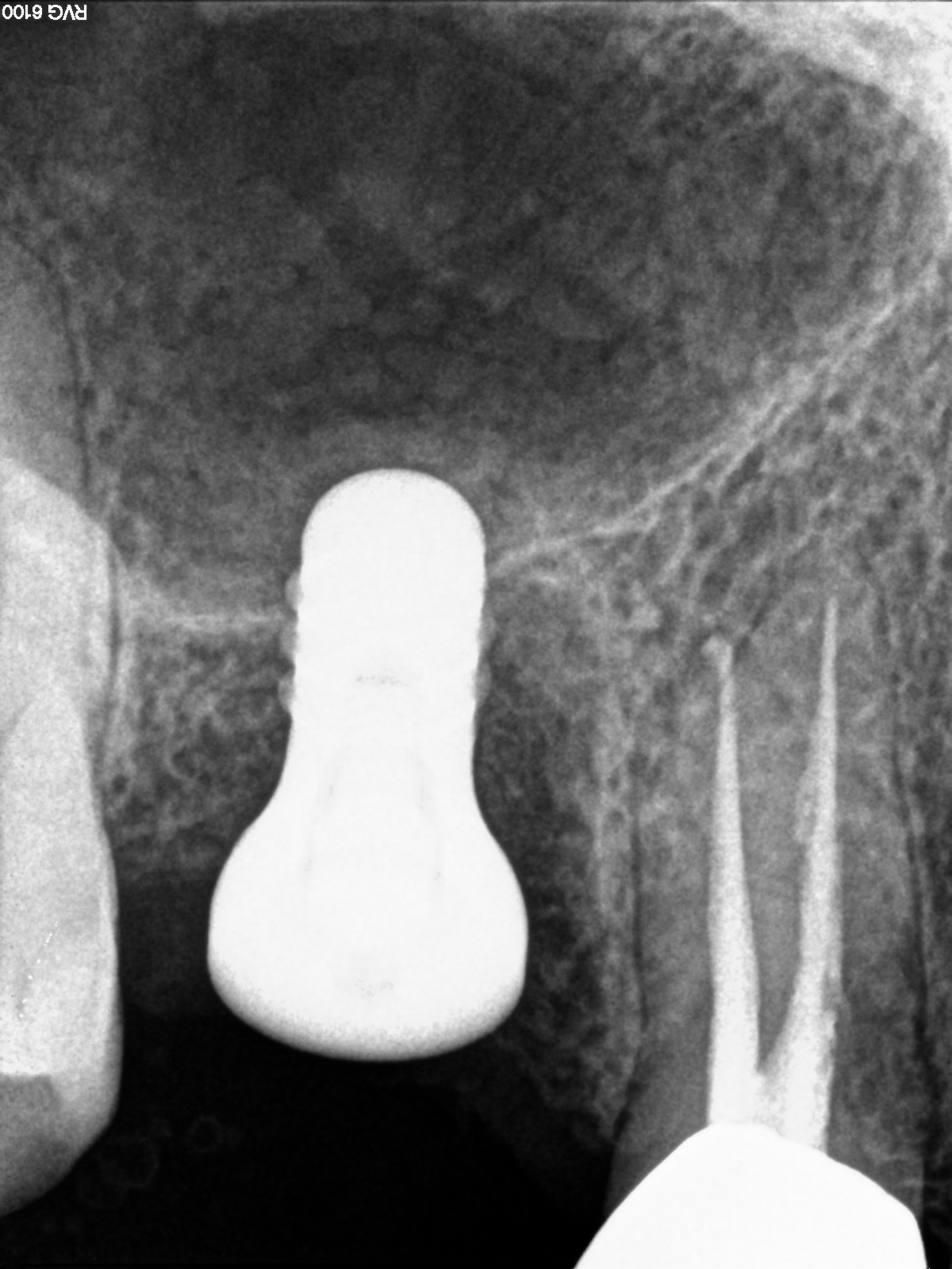 6) Post operative placement – Modern Endodontic Care