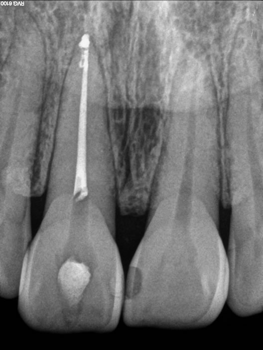 4) Root canal completed and bleaching material placed – Modern ...