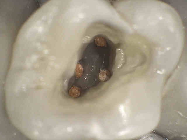 Access Closure: Case #8 – Modern Endodontic Care