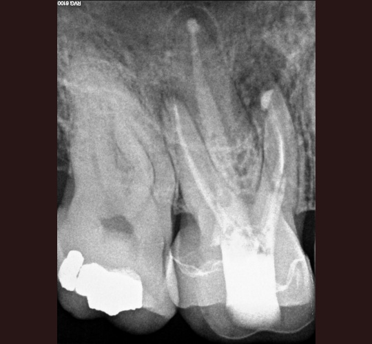 Access Closure: Case #4 – Modern Endodontic Care