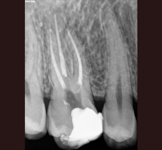 Access Closure: Case #7 – Modern Endodontic Care