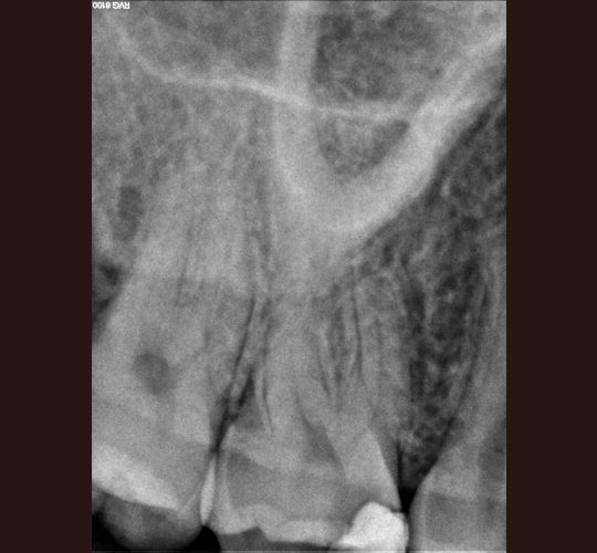 Access Closure: Case #7 – Modern Endodontic Care