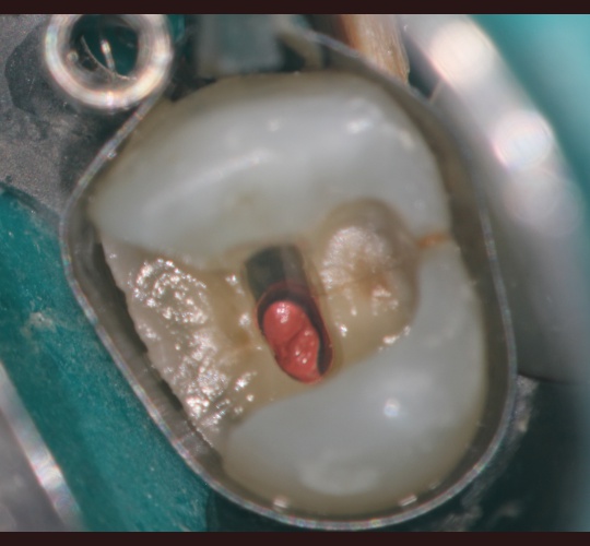 Crown Build-up: Case #4 – with bicuspid teeth they are more prone to ...