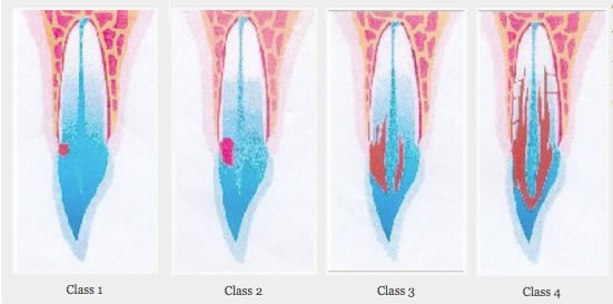 Extra Canal Invasive Resorption (ECIR) | Mondern Endodontic Care